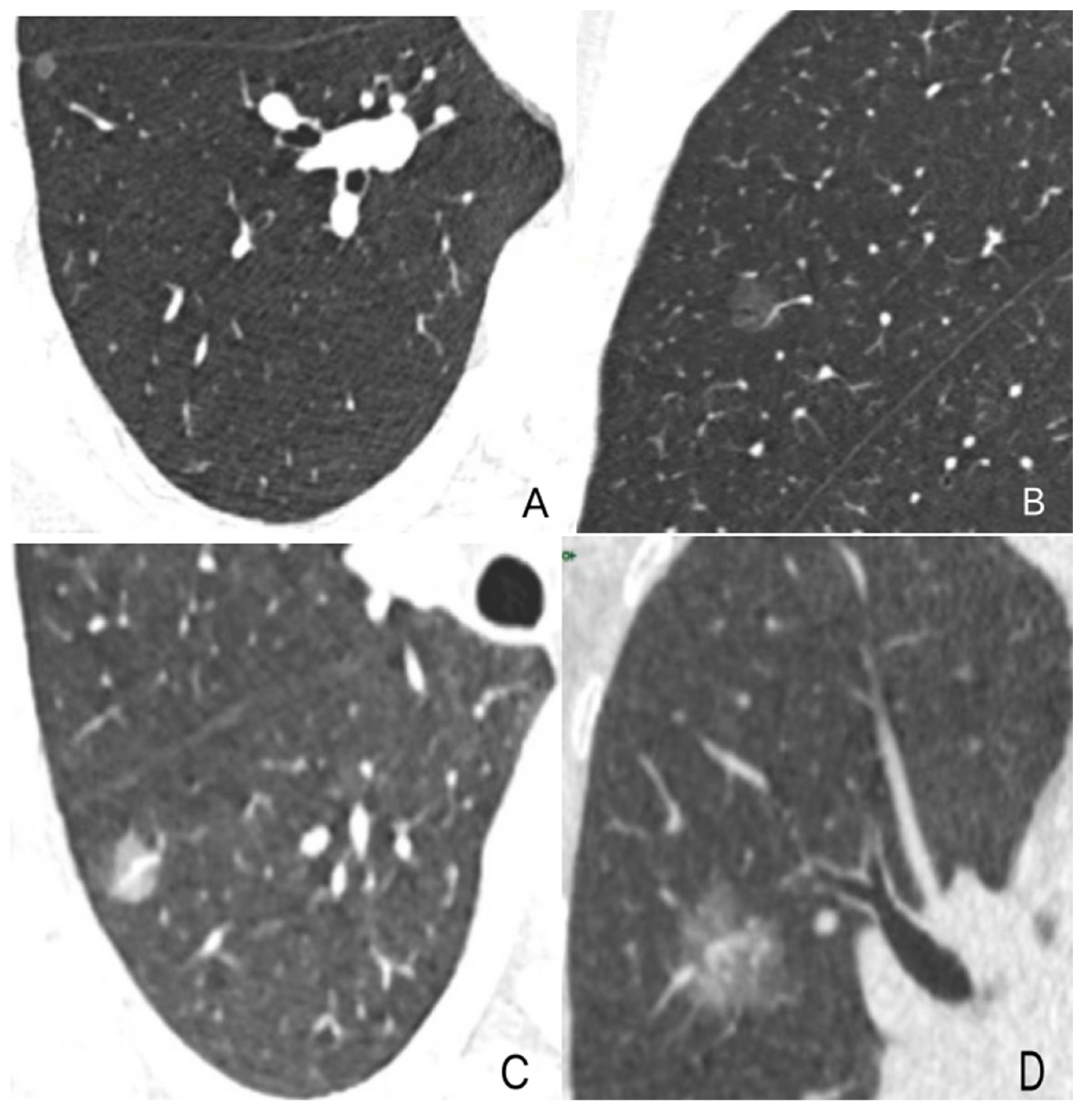Diagnostics | Free Full-Text | Proposal of Modified Lung-RADS in Assessing Pulmonary Nodules of ...