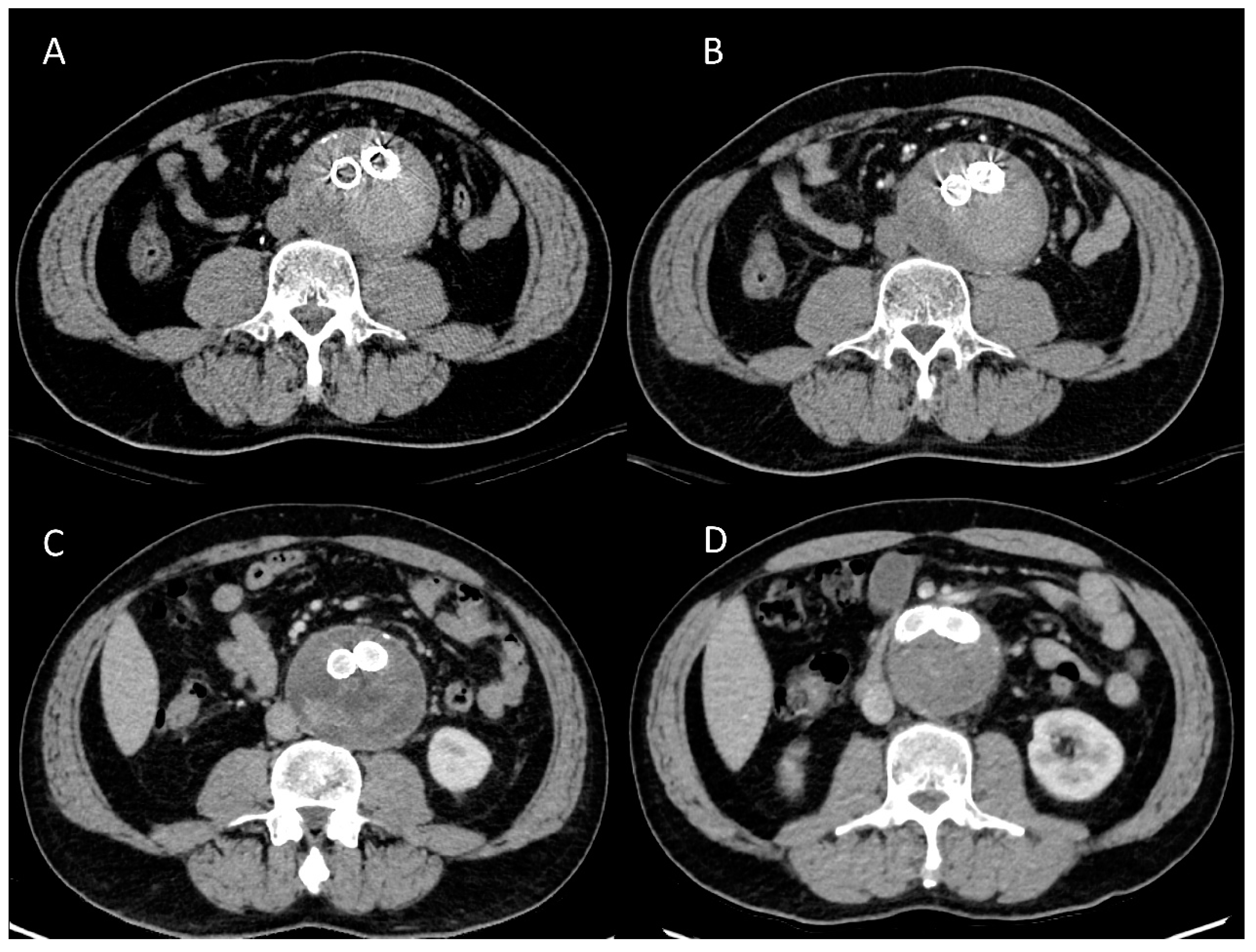 Can Low-Iodine, Low-Radiation-Dose CT Aortogram Reliably Detect ...