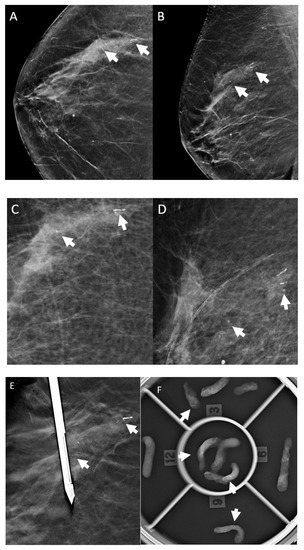Stepwise Implementation of 2D Synthesized Screening Mammography and Its ...