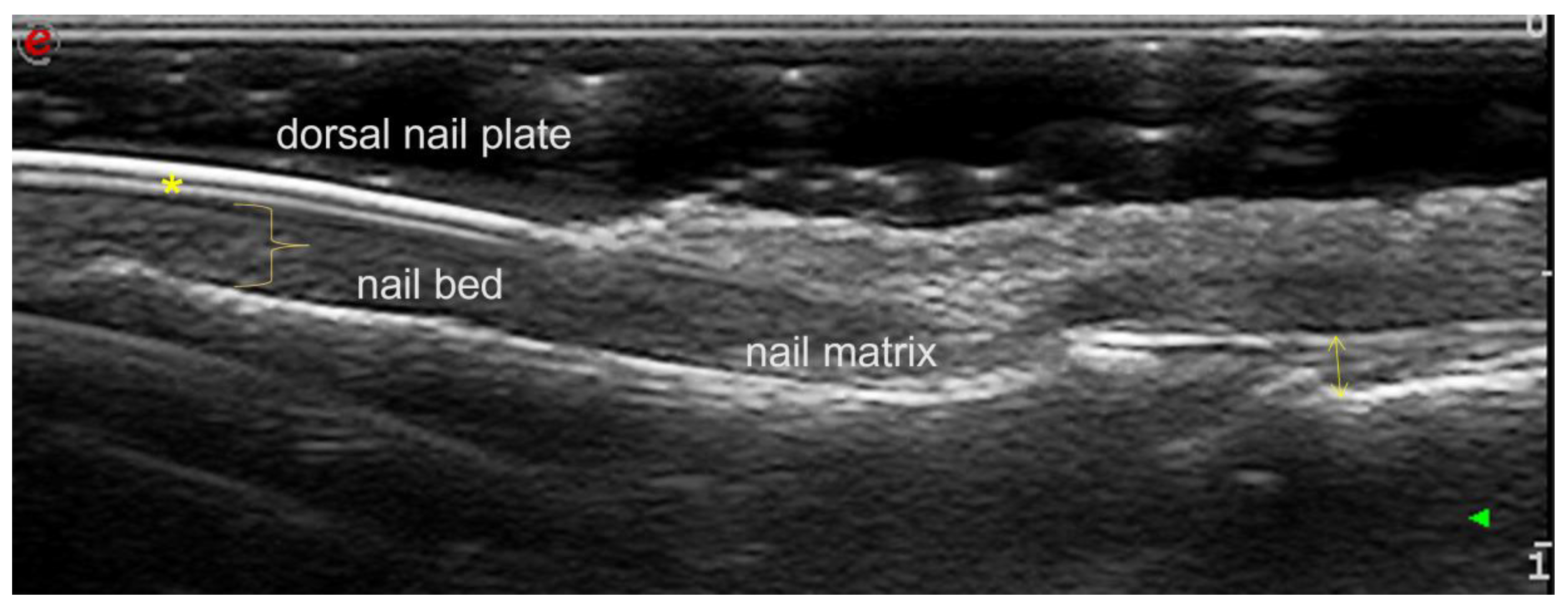 Nail Ultrasound in Psoriasis and Psoriatic Arthritis—A Narrative Review