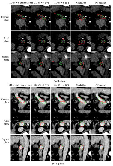 Segmentation of Portal Vein in Multiphase CTA Image Based on Unsupervised Domain Transfer and ...
