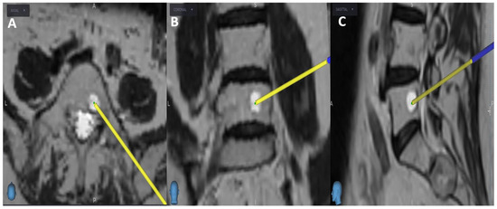 Diagnostics | Free Full-Text | Percutaneous Superimposed O-Arm-MRI ...