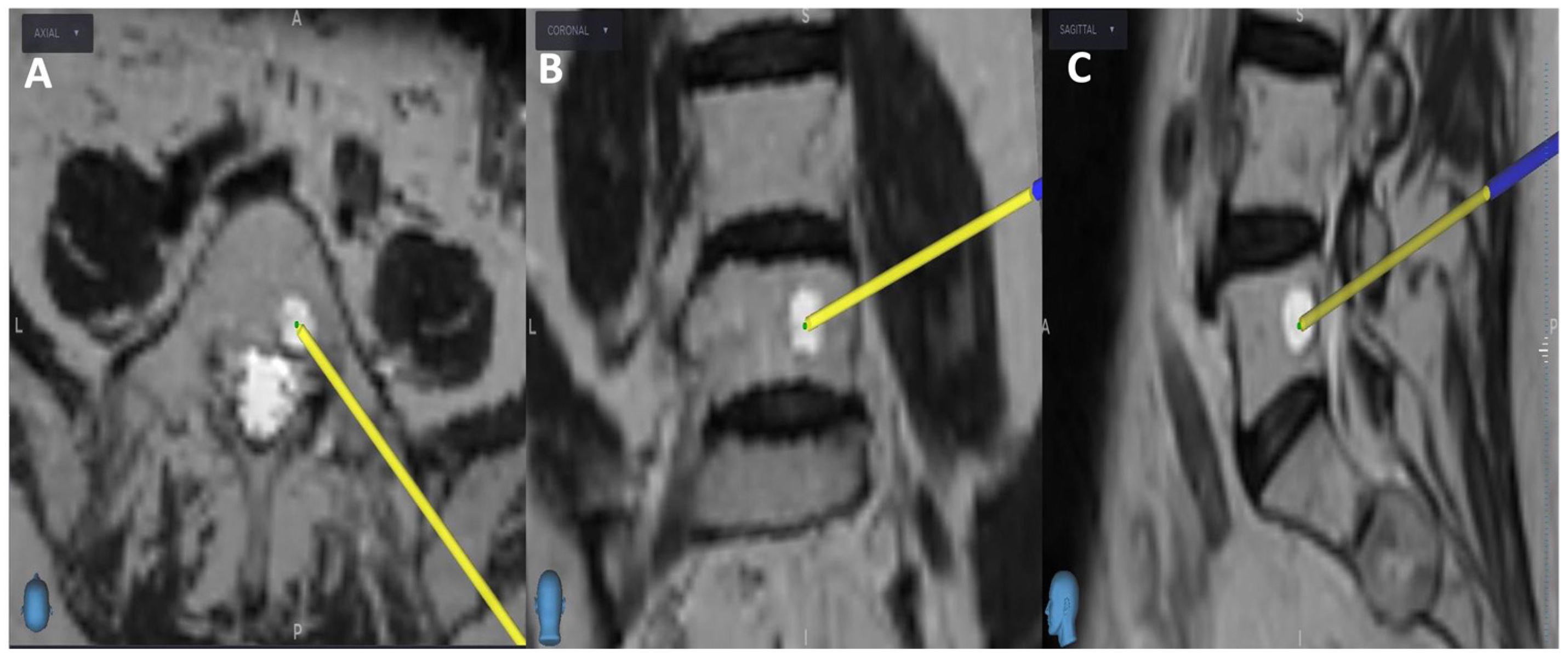 Diagnostics | Free Full-Text | Percutaneous Superimposed O-Arm-MRI ...