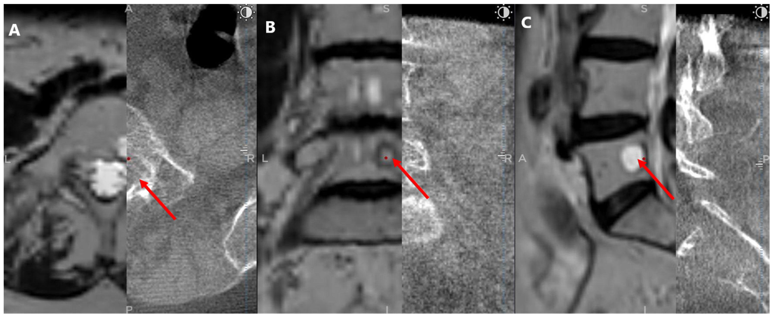 Diagnostics | Free Full-Text | Percutaneous Superimposed O-Arm-MRI ...