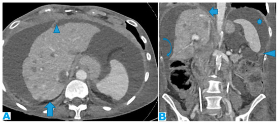Unravelling Peritoneal Carcinomatosis Using Cross-Sectional Imaging ...