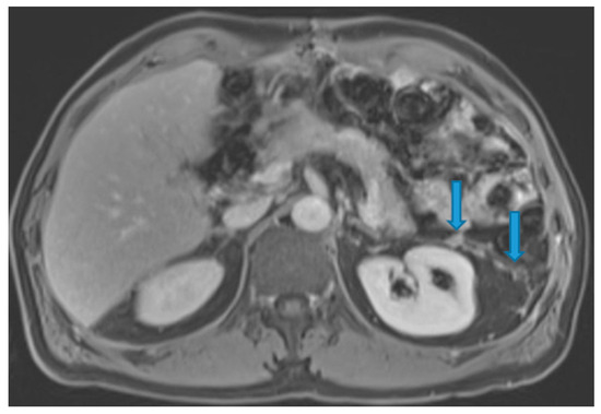 Unravelling Peritoneal Carcinomatosis Using Cross-Sectional Imaging ...