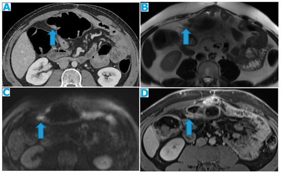 Unravelling Peritoneal Carcinomatosis Using Cross-Sectional Imaging ...