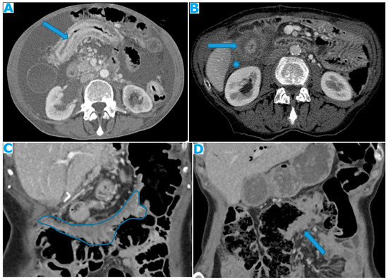 Unravelling Peritoneal Carcinomatosis Using Cross-Sectional Imaging ...