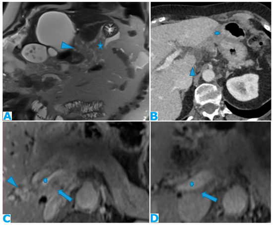 Unravelling Peritoneal Carcinomatosis Using Cross-Sectional Imaging ...