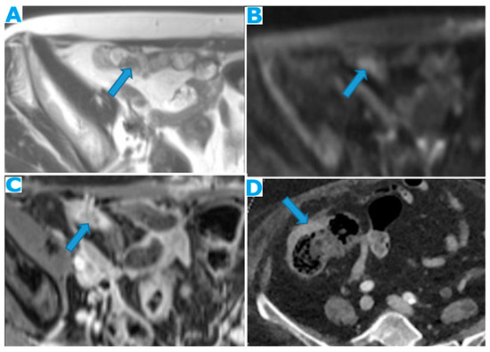 Unravelling Peritoneal Carcinomatosis Using Cross-Sectional Imaging ...