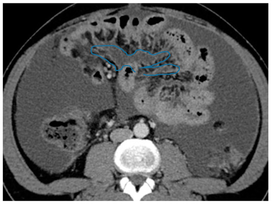 Unravelling Peritoneal Carcinomatosis Using Cross-Sectional Imaging ...