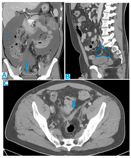 Unravelling Peritoneal Carcinomatosis Using Cross-Sectional Imaging ...