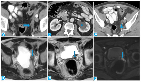 Unravelling Peritoneal Carcinomatosis Using Cross-Sectional Imaging ...
