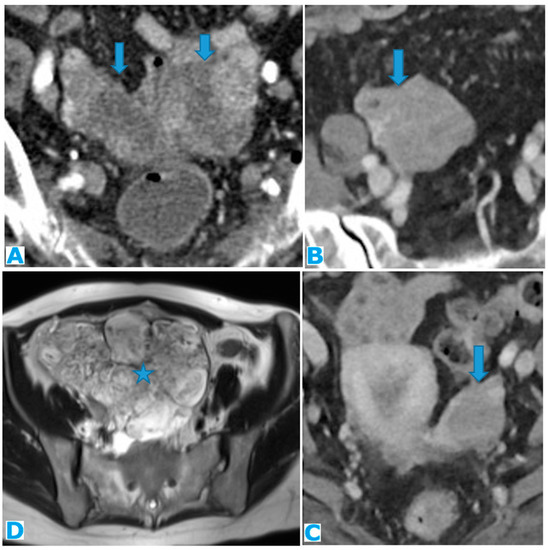 Unravelling Peritoneal Carcinomatosis Using Cross-Sectional Imaging ...