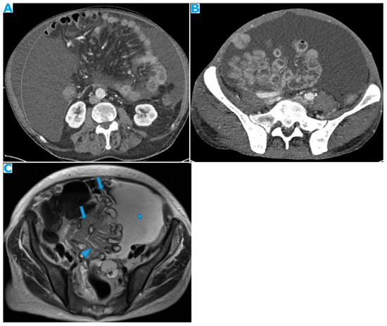Unravelling Peritoneal Carcinomatosis Using Cross-Sectional Imaging ...