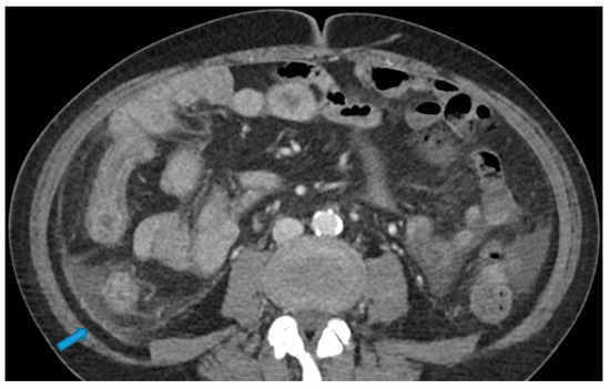 Unravelling Peritoneal Carcinomatosis Using Cross-Sectional Imaging ...