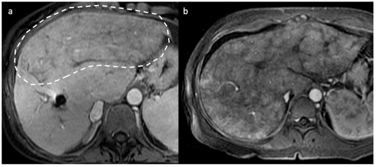 Budd-Chiari Syndrome Imaging Diagnosis: State of the Art and Future ...
