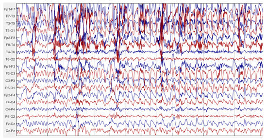 Diagnostics | Free Full-Text | Identification of TLE Focus from EEG Signals by Using Deep ...
