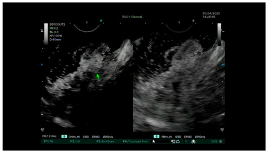 Usefulness of Contrast-Enhanced Endoscopic Ultrasound (CH-EUS) to Guide ...
