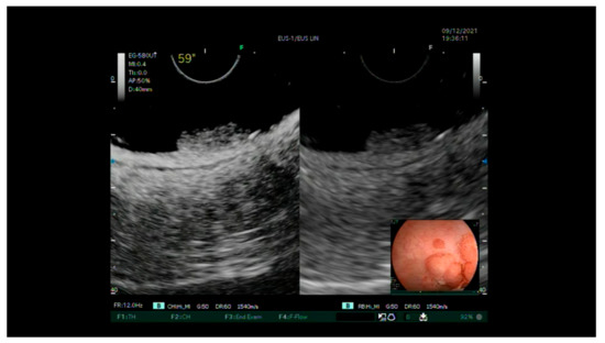 Usefulness of Contrast-Enhanced Endoscopic Ultrasound (CH-EUS) to Guide ...