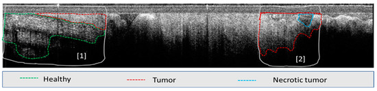 Core Needle Biopsy Guidance Based on Tissue Morphology Assessment with ...
