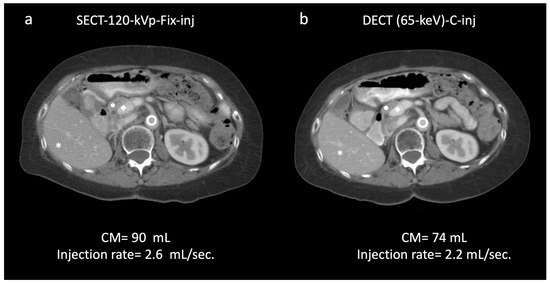Optimal Abdominal CT Image Quality in Non-Lean Patients: Customization ...