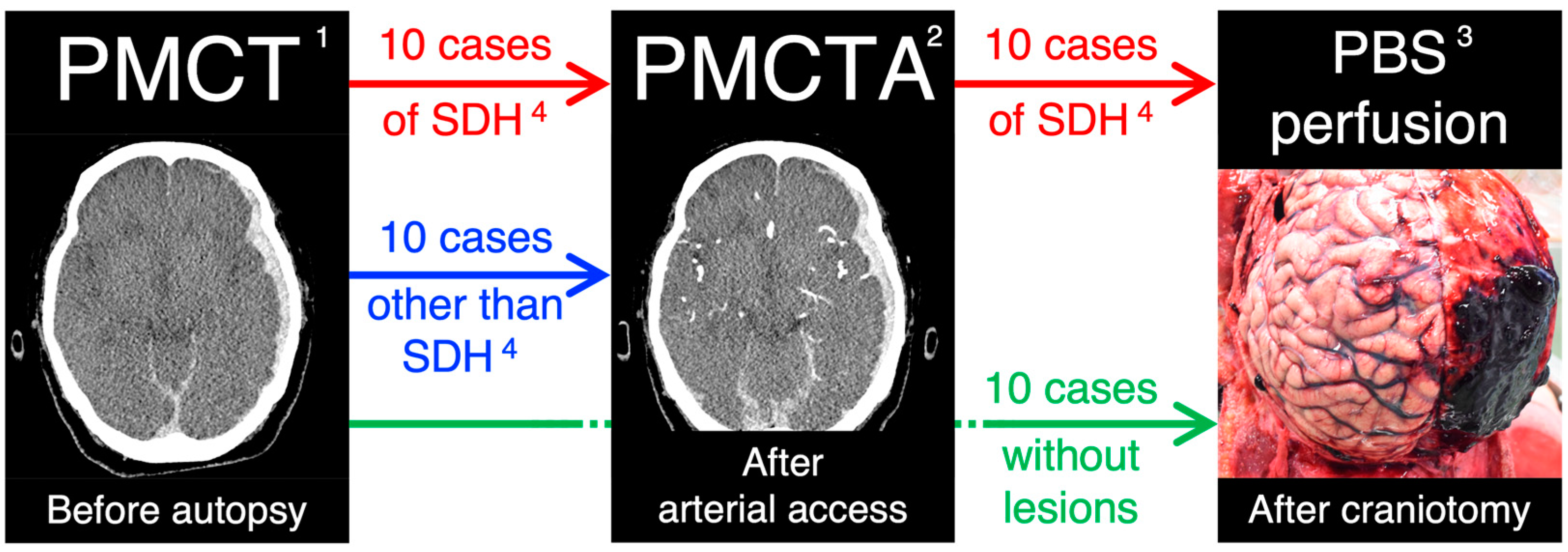 Bleeding-Source Exploration in Subdural Hematoma: Observational Study ...
