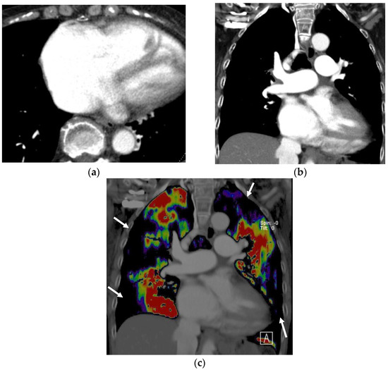 Advances for Pulmonary Functional Imaging: Dual-Energy Computed ...