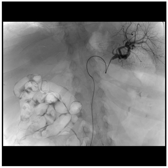 Direct Endoscopic Necrosectomy of a Recurrent Walled-Off Pancreatic ...