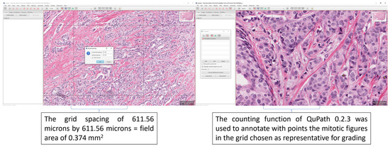 Comparative Evaluation of Breast Ductal Carcinoma Grading: A Deep-Learning Model and General ...