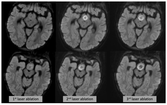 Intraoperative MRI Assessment of the Tissue Damage during Laser ...