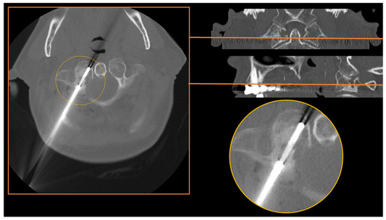Percutaneous CT-Guided Bone Biopsies: Indications, Feasibility and ...