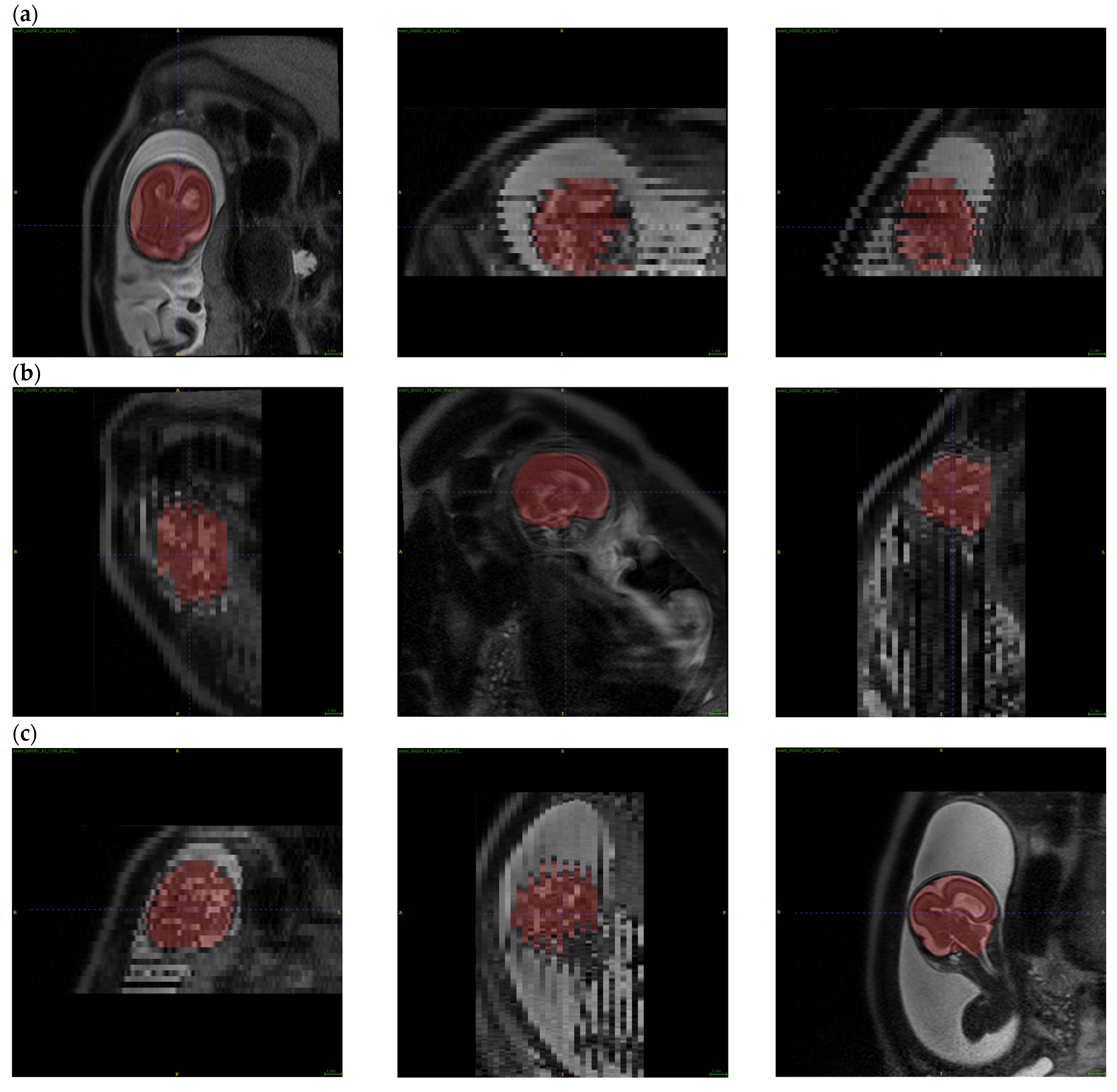Diagnostics | Free Full-Text | Automatic Ventriculomegaly Detection in Fetal Brain MRI: A Step ...