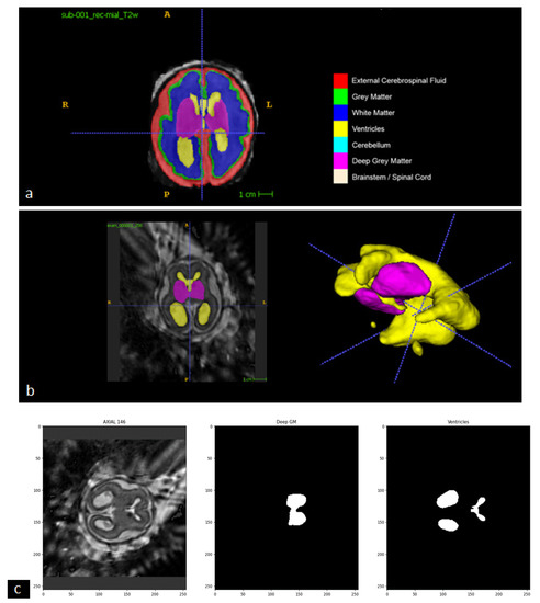 Diagnostics | Free Full-Text | Automatic Ventriculomegaly Detection in Fetal Brain MRI: A Step ...