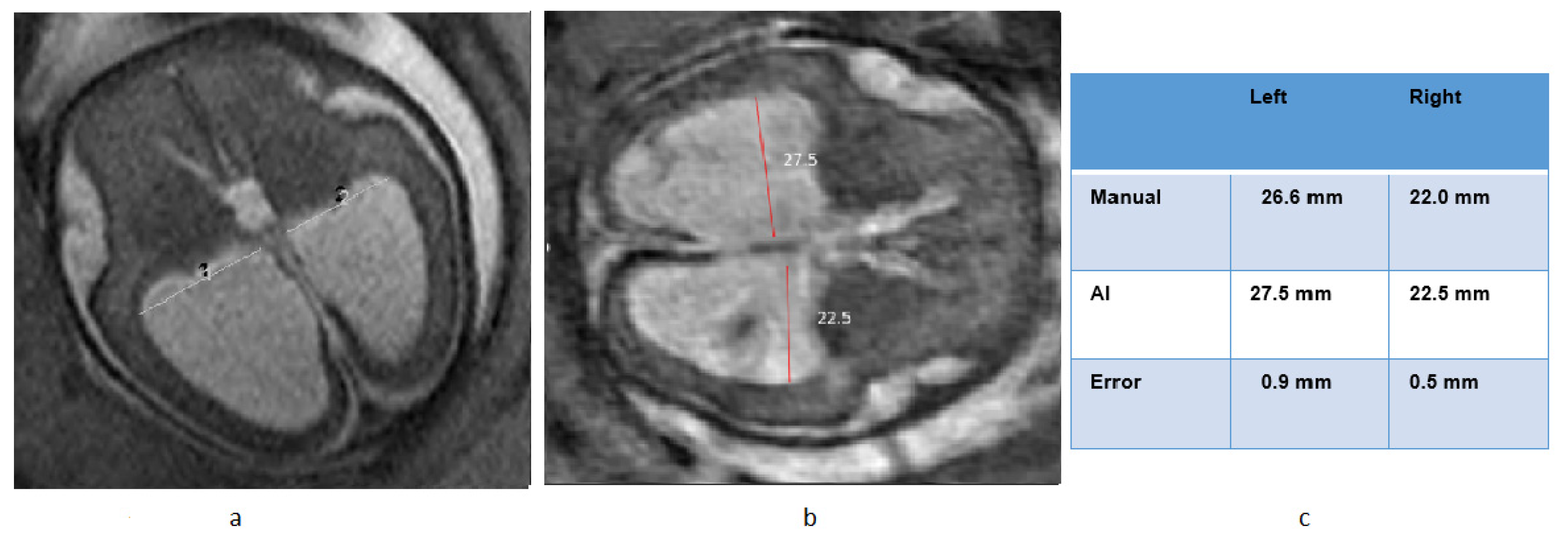 Automatic Ventriculomegaly Detection in Fetal Brain MRI: A Step-by-Step ...