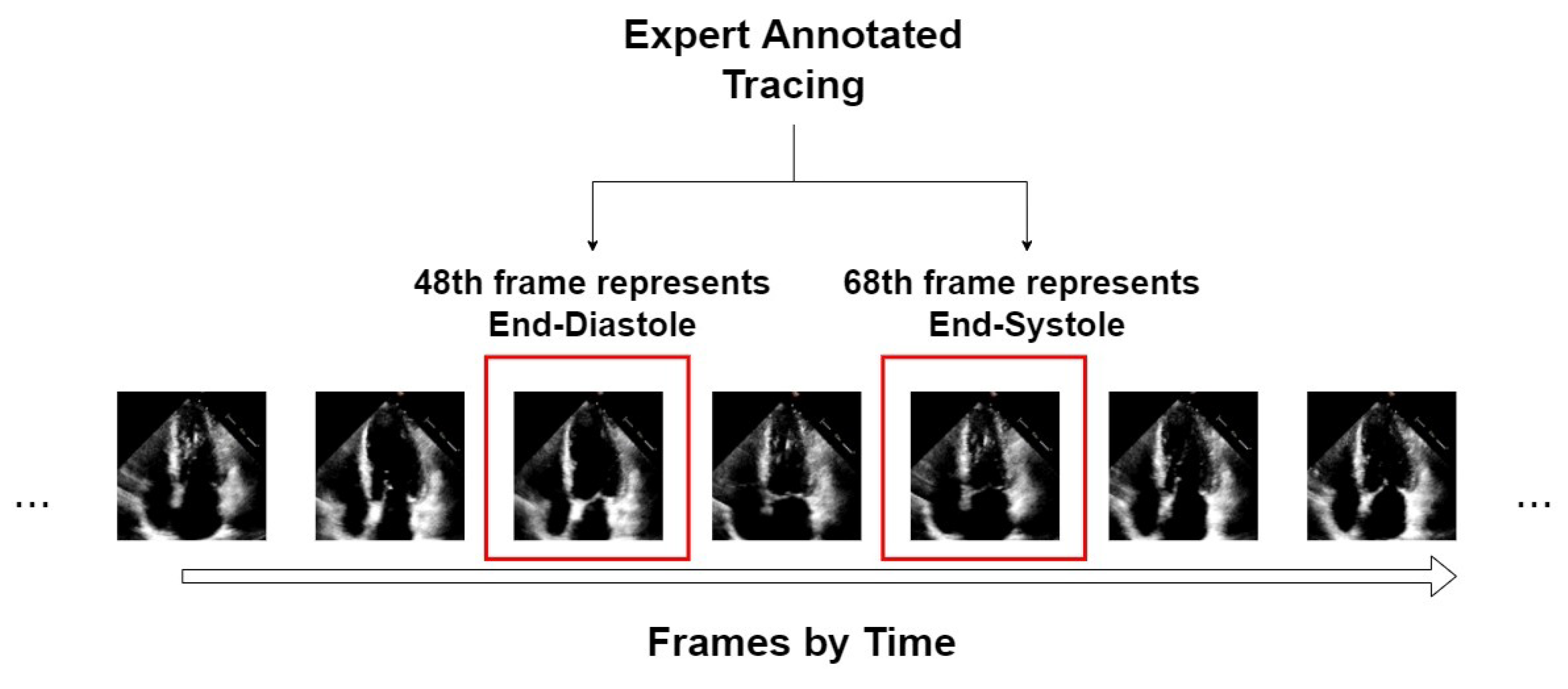 Left Ventricle Segmentation in Echocardiography with Transformer