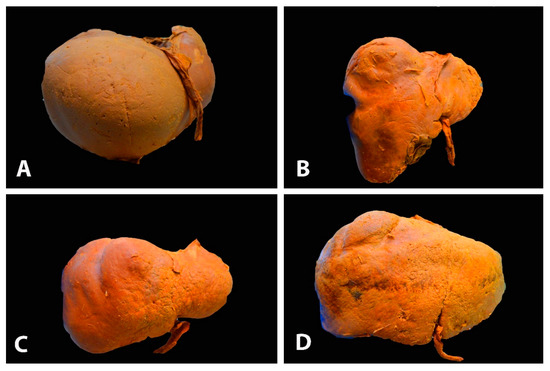 Surgical Anatomy of the Liver—Significance in Ovarian Cancer Surgery
