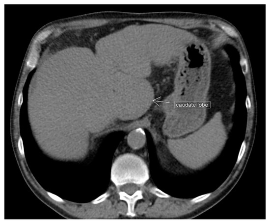 Surgical Anatomy of the Liver—Significance in Ovarian Cancer Surgery