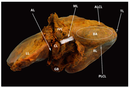 Surgical Anatomy of the Liver—Significance in Ovarian Cancer Surgery