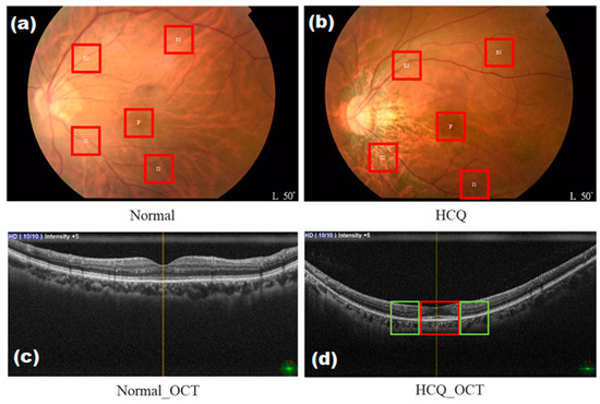 Diagnostics | Free Full-Text | Detection of Hydroxychloroquine ...