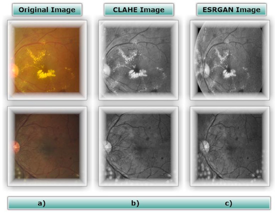 Enhancement of Diabetic Retinopathy Prognostication Using Deep Learning ...