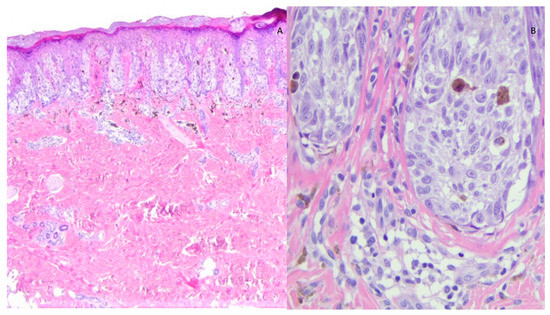 Paediatric Spitzoid Neoplasms: 10-Year Retrospective Study ...
