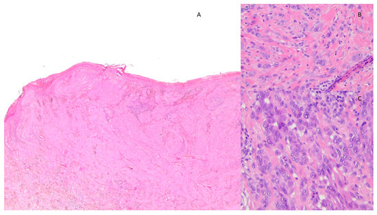 Paediatric Spitzoid Neoplasms: 10-Year Retrospective Study ...