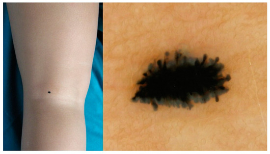 Paediatric Spitzoid Neoplasms: 10-Year Retrospective Study ...