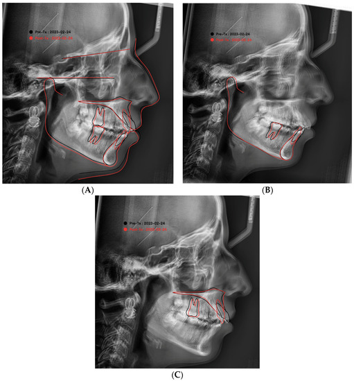 Occlusal Plane Steepness and Profile Change Following TAD-Based One ...
