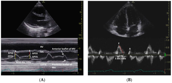 A Pilot Study Evaluating LV Diastolic Function with M-Mode Measurement ...