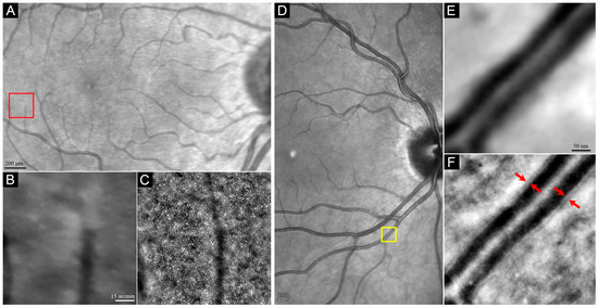 Pearls and Pitfalls of Adaptive Optics Ophthalmoscopy in Inherited ...