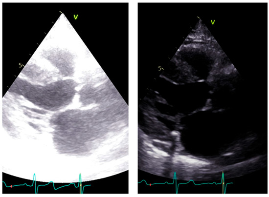 Pitfalls and Tips in the Assessment of Aortic Stenosis by Transthoracic ...