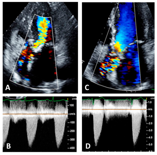 Pitfalls and Tips in the Assessment of Aortic Stenosis by Transthoracic ...