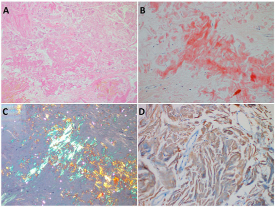 Localized Insulin-Derived Amyloidosis in Diabetes Mellitus Type 1 ...